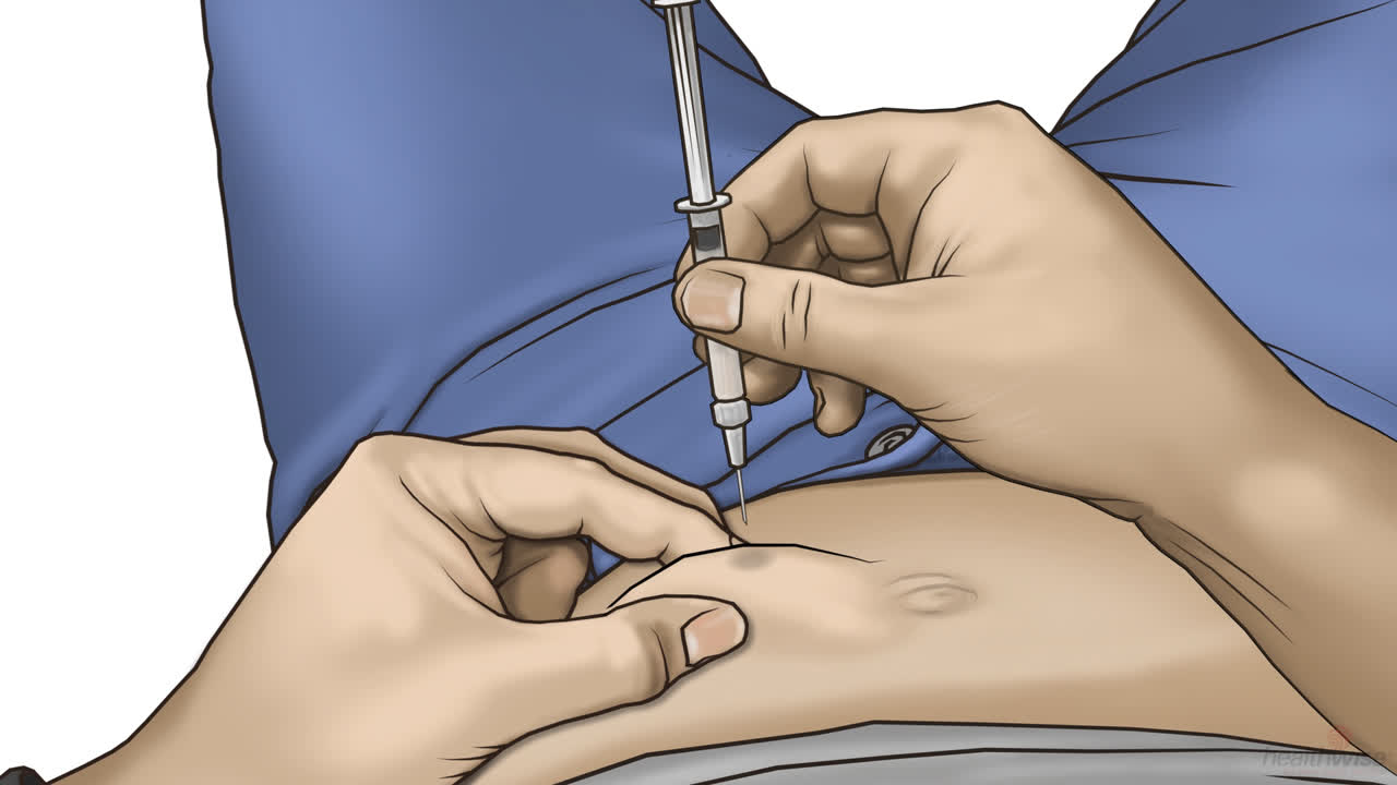 Subcutaneous Injection Technique